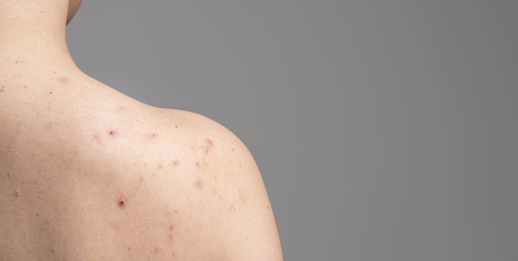 Puistjes op rug voorkomen en behandelen | Blog | Toskani