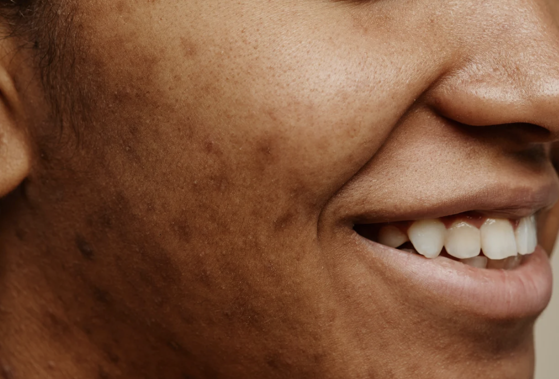 Acne littekens, beter voorkomen dan genezen | Blog | Toskani