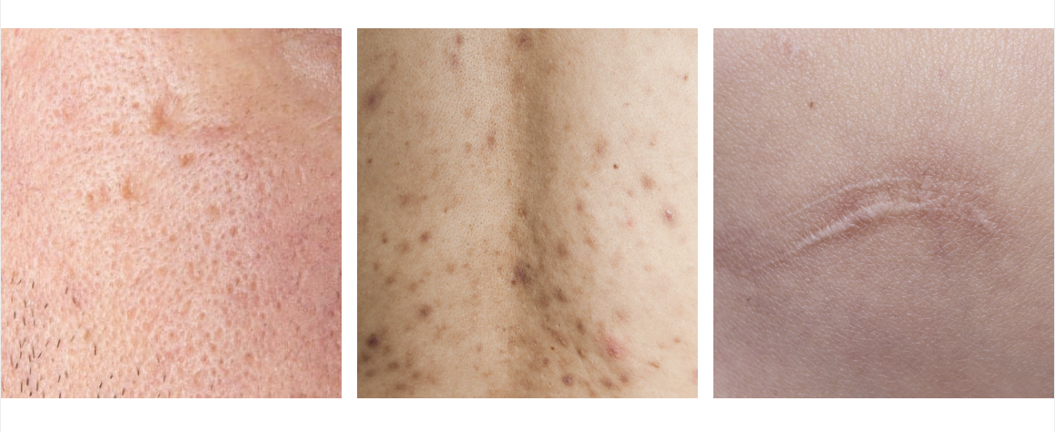 Acne littekens beter voorkomen dan genezen – Toskani